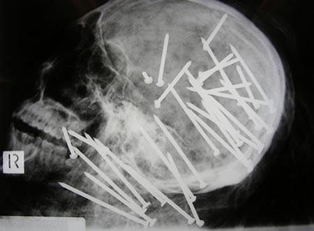 15 Crazy X-Ray Photos That Will Make You SO Thankful You’re Not A ...